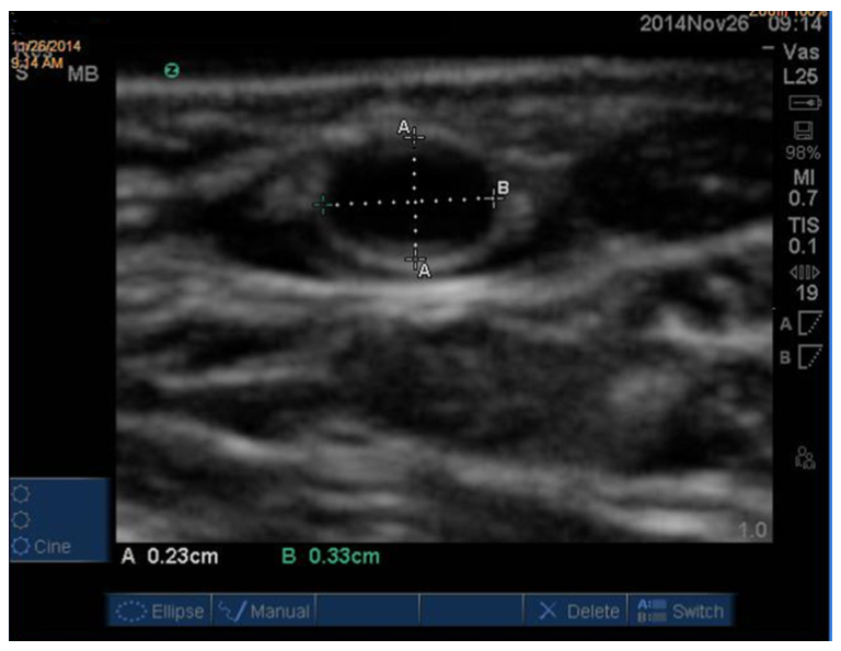 Ultrasound Survey of Radial and Ulnar Arteries | J Invasive Cardiol