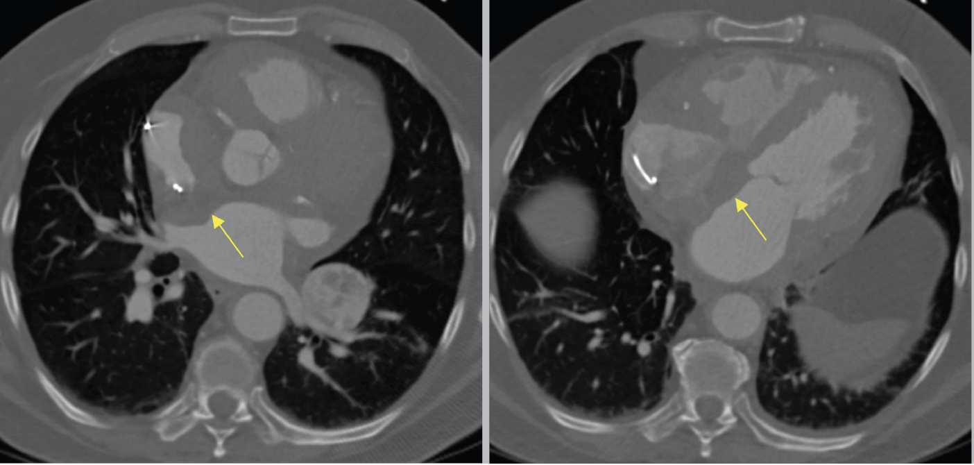 Right Atrial Mass Biopsy Using Endobronchial Forceps | J INVASIVE CARDIOL