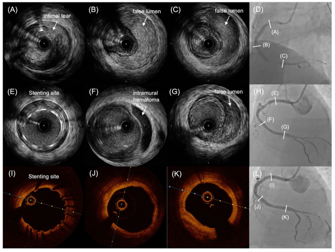 Optical Coherence Tomography Confirms Artery Dissection Healing
