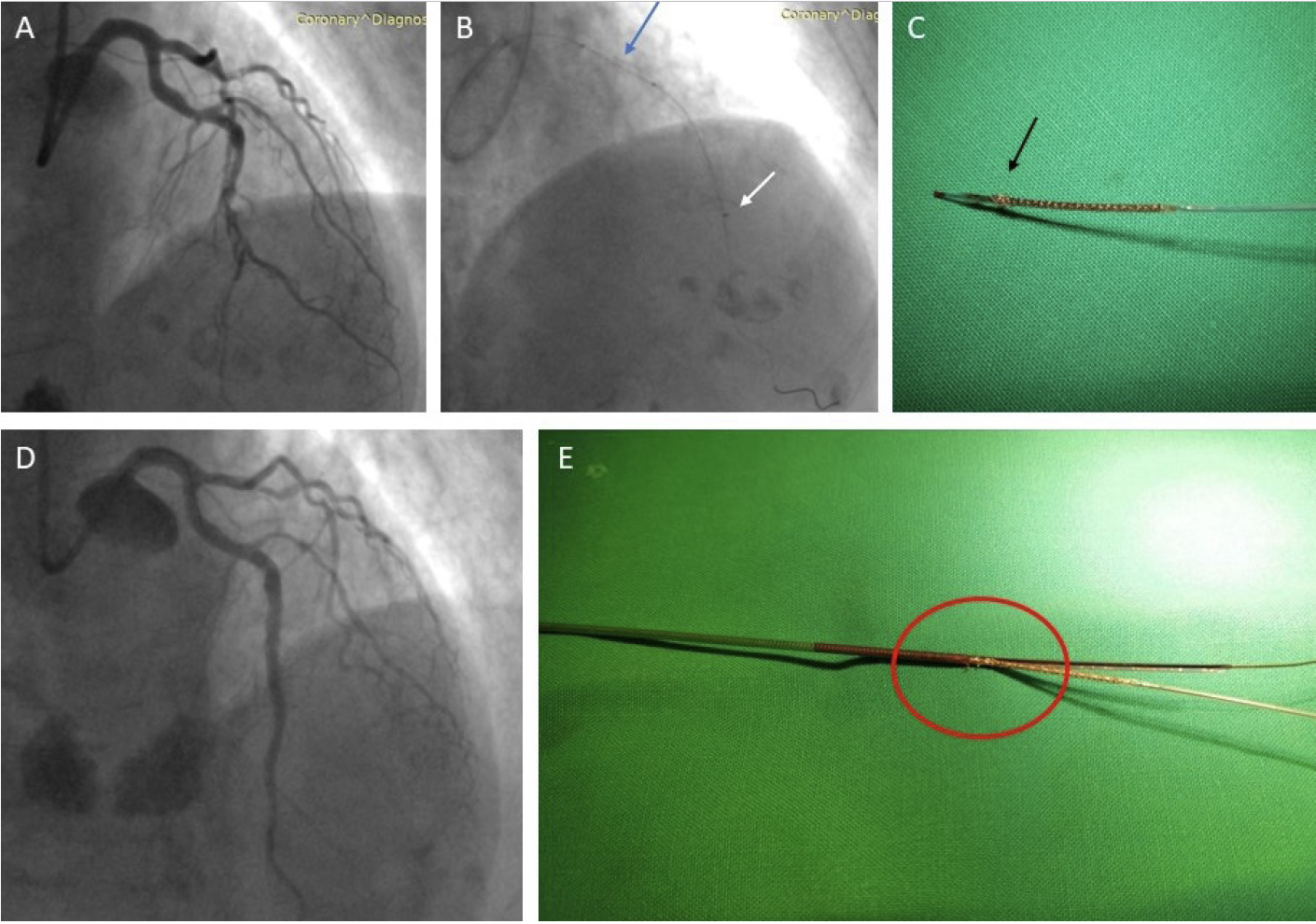 Stent Damage From a Guide Catheter Extension During PCI