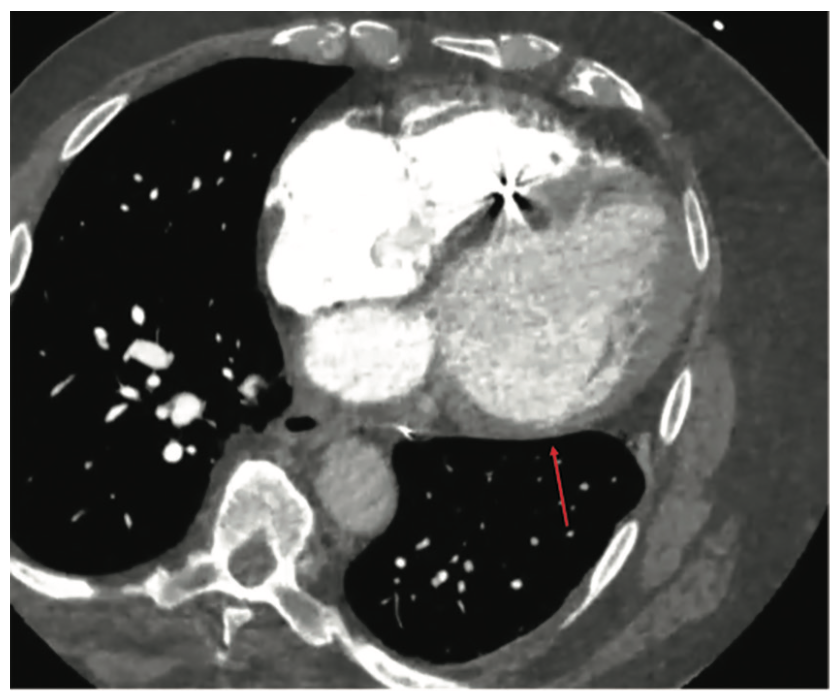 Epicardial Ventricular Tachycardia Ablation for Nonischemic Cardiomyopathy