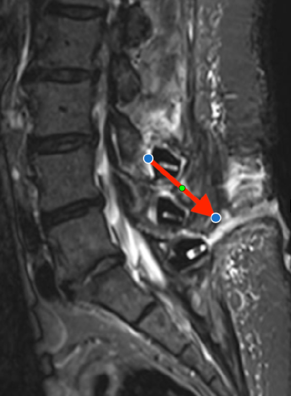 Noninfectious Skin Fistulization as a Delayed Complication of Lumbar ...