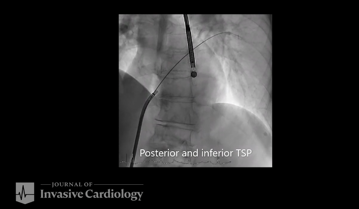 Amplatzer Steerable Delivery Sheath in Complex LAA Occlusion