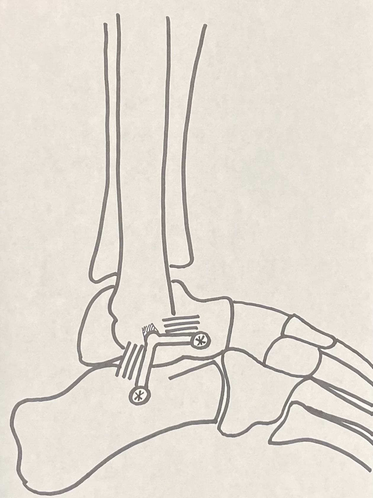 A Modified Technique for Augmentation of Chronic Lateral Ankle ...