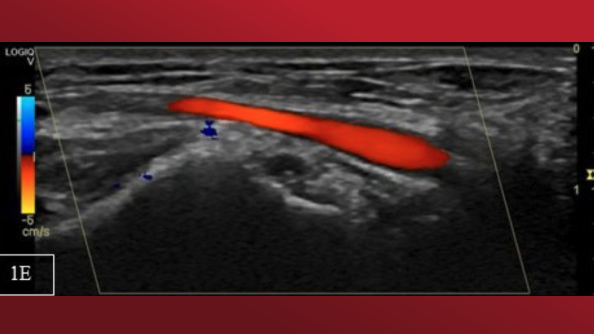 Radial Artery Spasm, Excision of Avulsed Fragment and Uncompromised ...