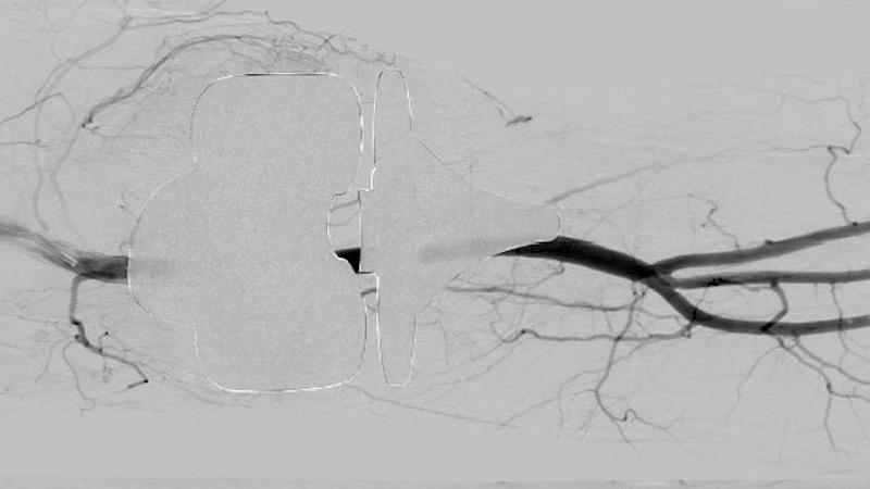 Geniculate Artery Embolization: A Review of Hemarthrosis and Osteoarthritis