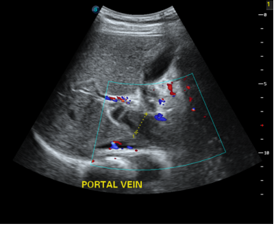 Symptomatic Acute Portomesenteric Venous Thrombosis | VDM