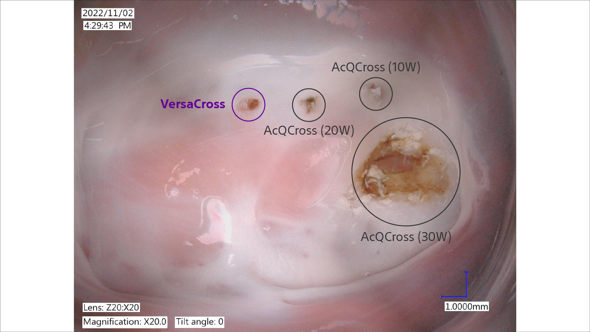 Comparison of Safety and Efficacy of Two Different Transseptal Puncture ...