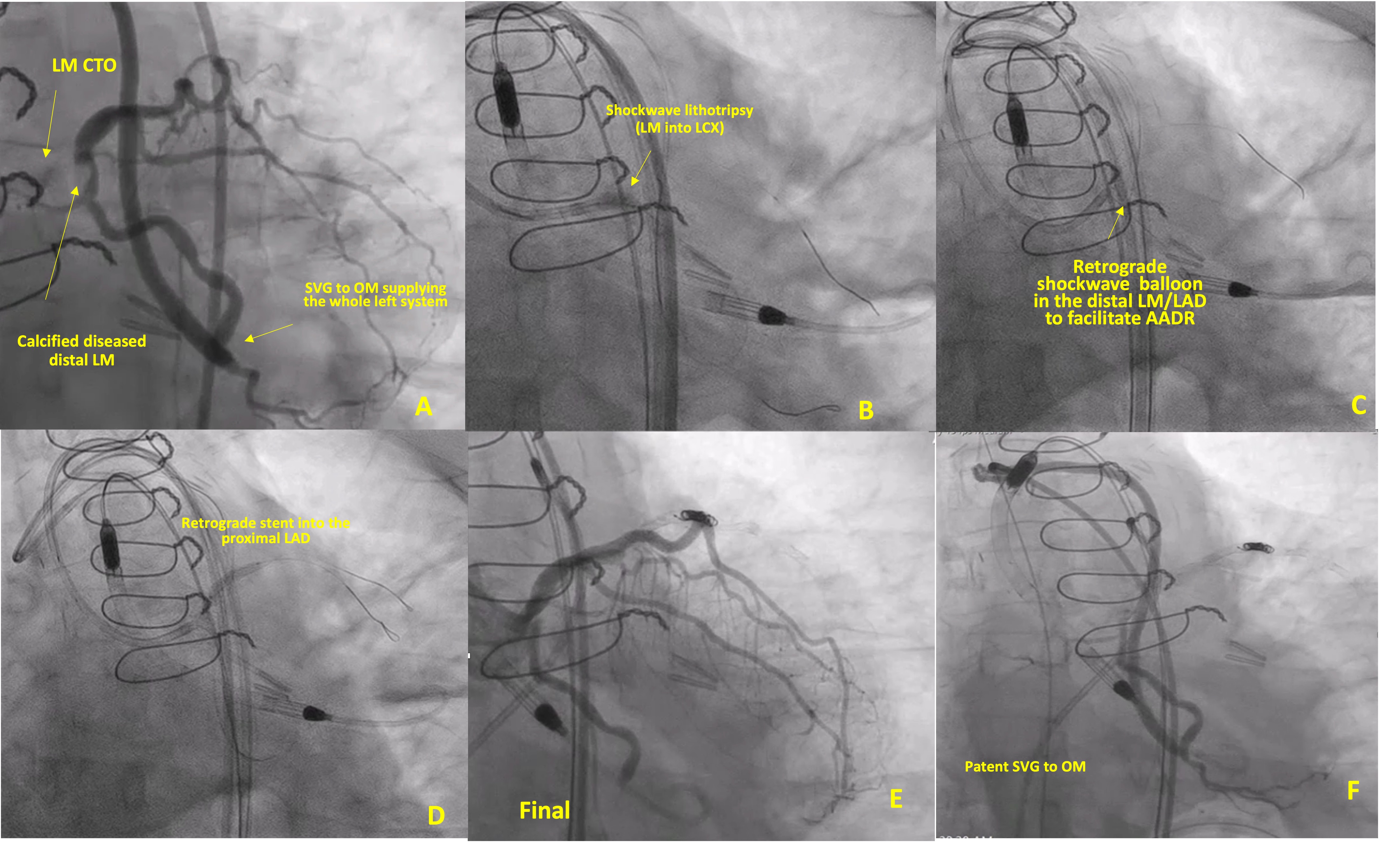 Retrograde Stent Target Technique for Left Main Chronic Total Occlusion ...