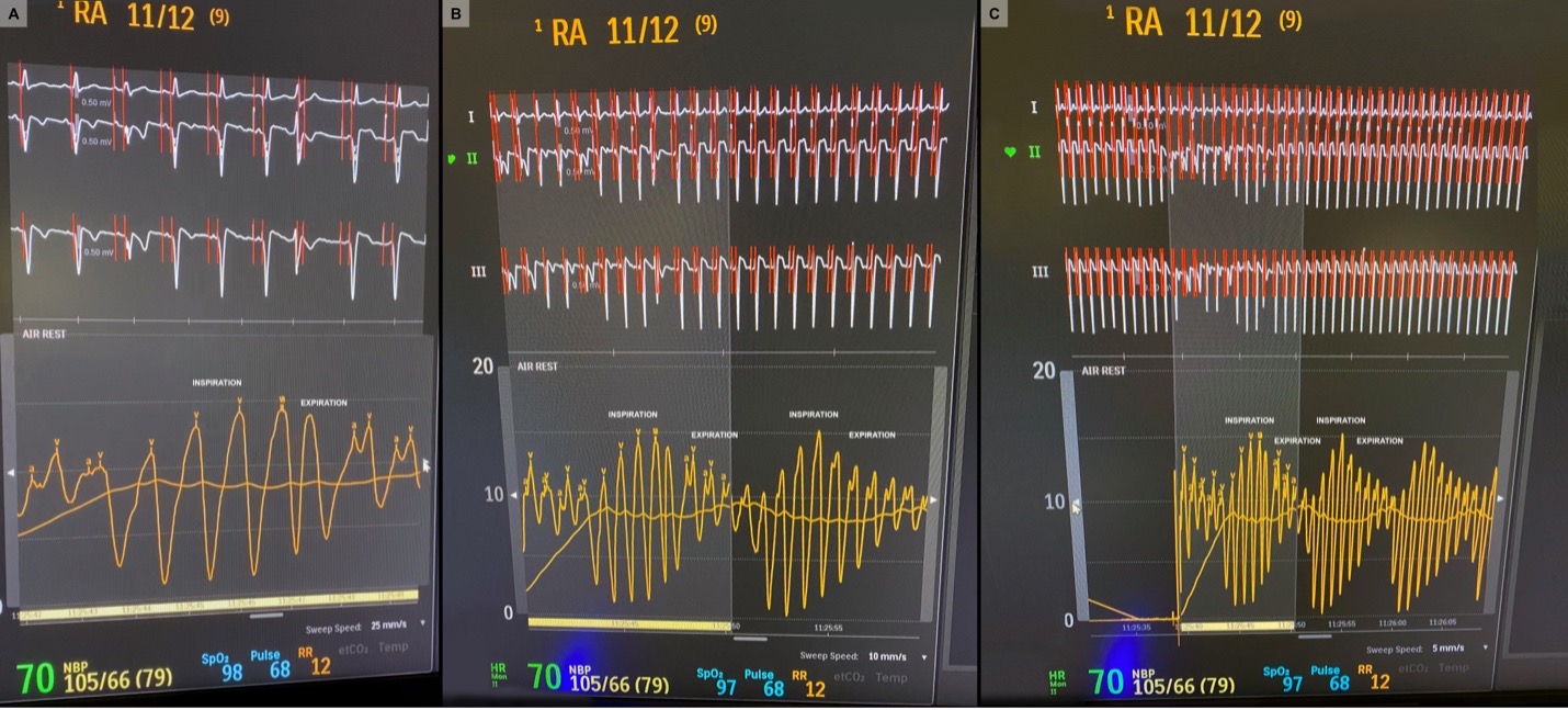 Right Atrial Pressure Torsades de Pointes