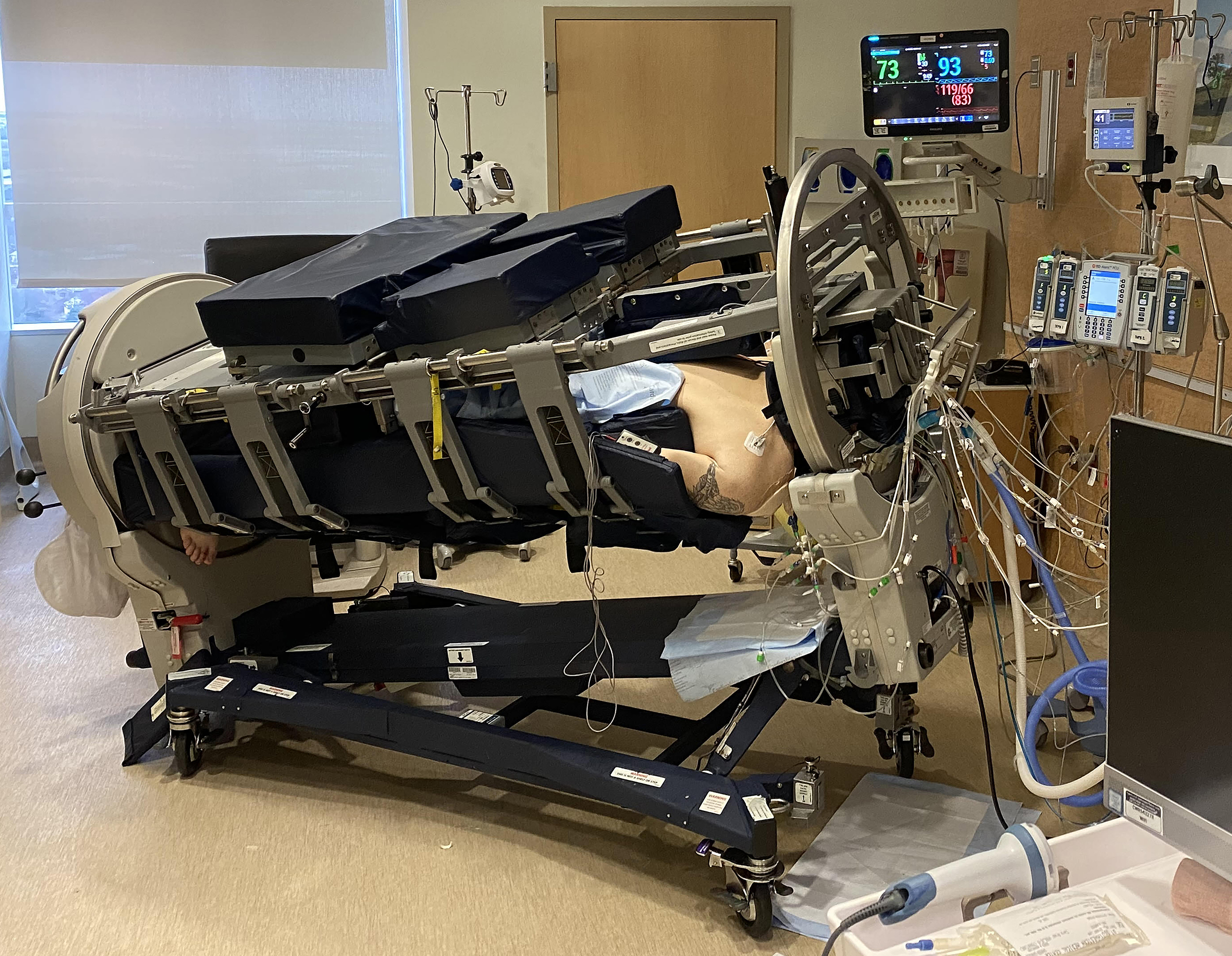 Bedside Popliteal Vein Cannulation for Simultaneous Plasmapheresis and ...