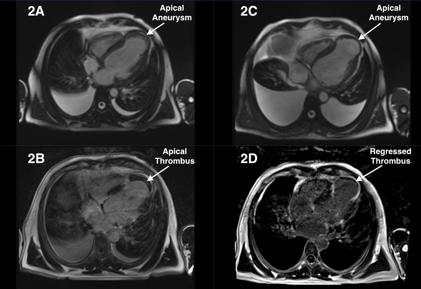 Apical Thrombus Mimicking Ventricular Septal Rupture