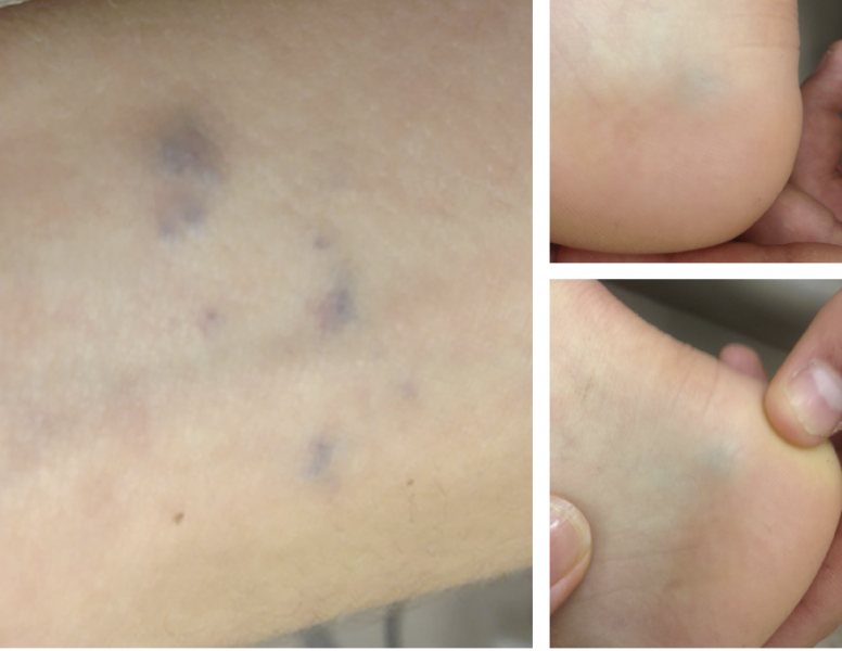 What Caused These Bluish Bumps?