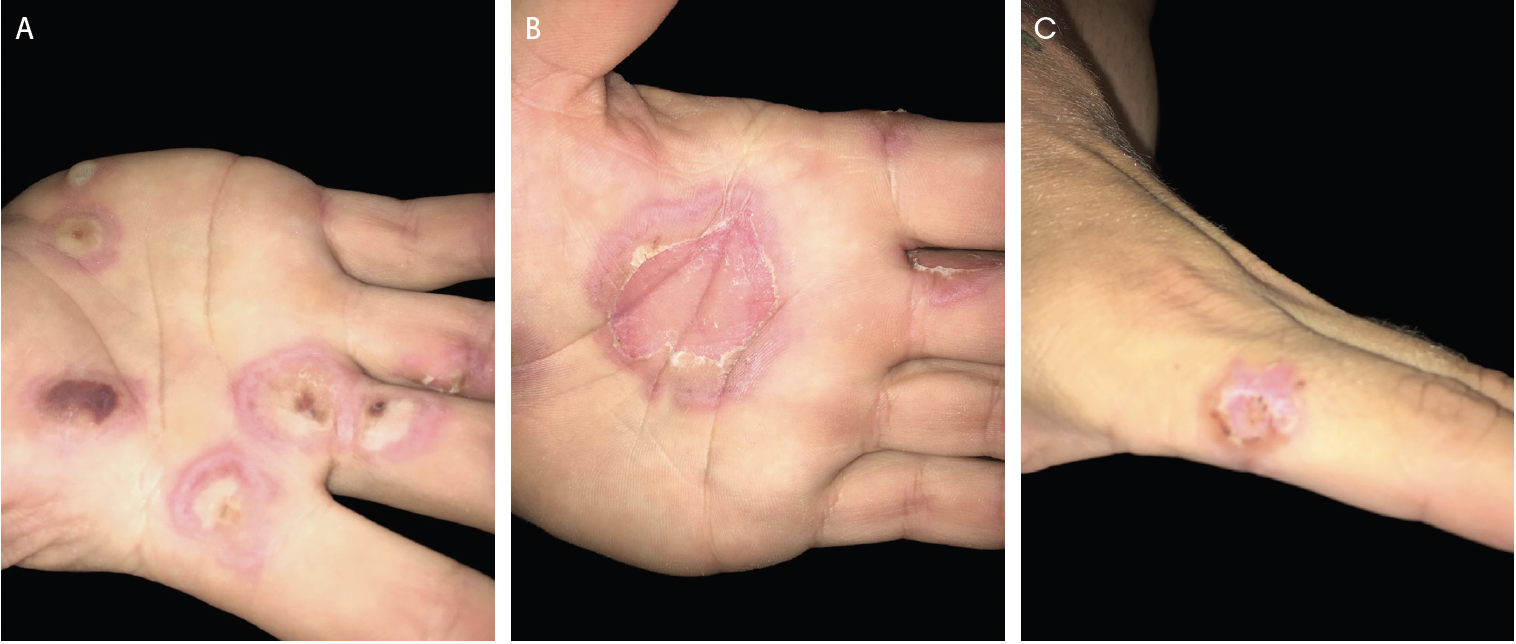 Treatment of Recurrent Erythema Multiforme in an Immunosuppressed Patient