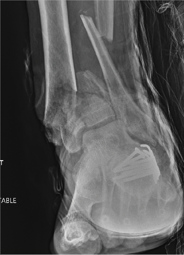 Expert Insights on Pilon Fracture Management | Podiatry Today