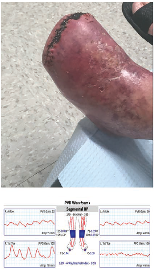 Transcatheter Arterialization of Deep Veins (TADV)