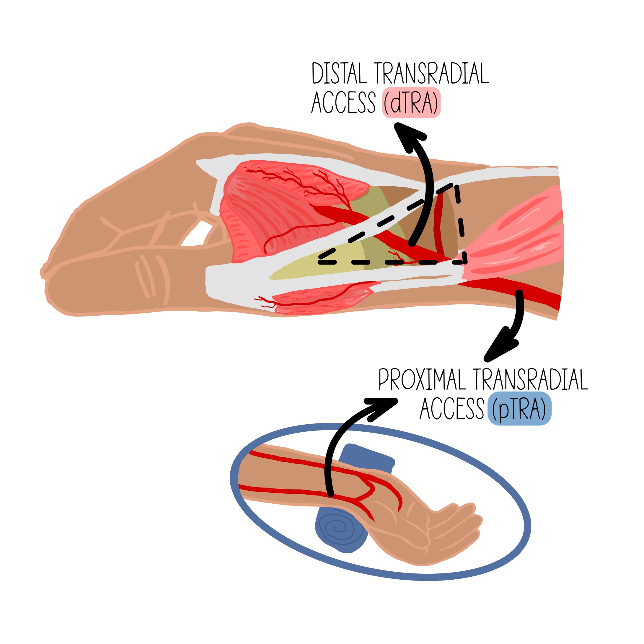 Ultra-Low Contrast Strategy for Routine Coronary Procedures via Distal ...