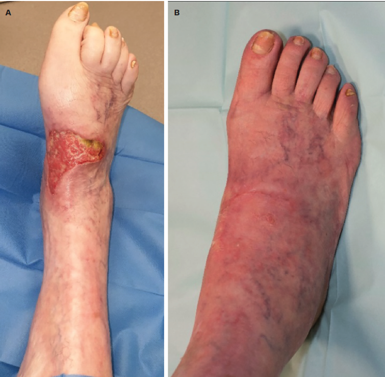 Is Nanofat the Long-Awaited Treatment for Hypertensive Ischemic Leg Ulcers?