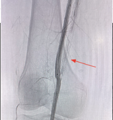 Percutaneous Transmural Arterial Bypass (PTAB) for Treatment of ...