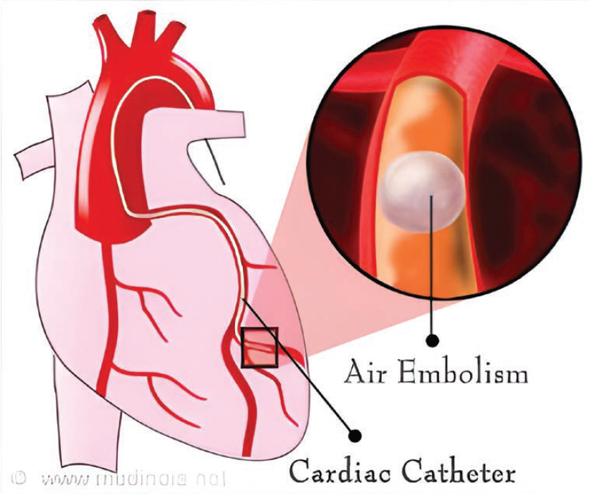 Air Embolus in the Cardiac Catheterization Laboratory – A Highly ...