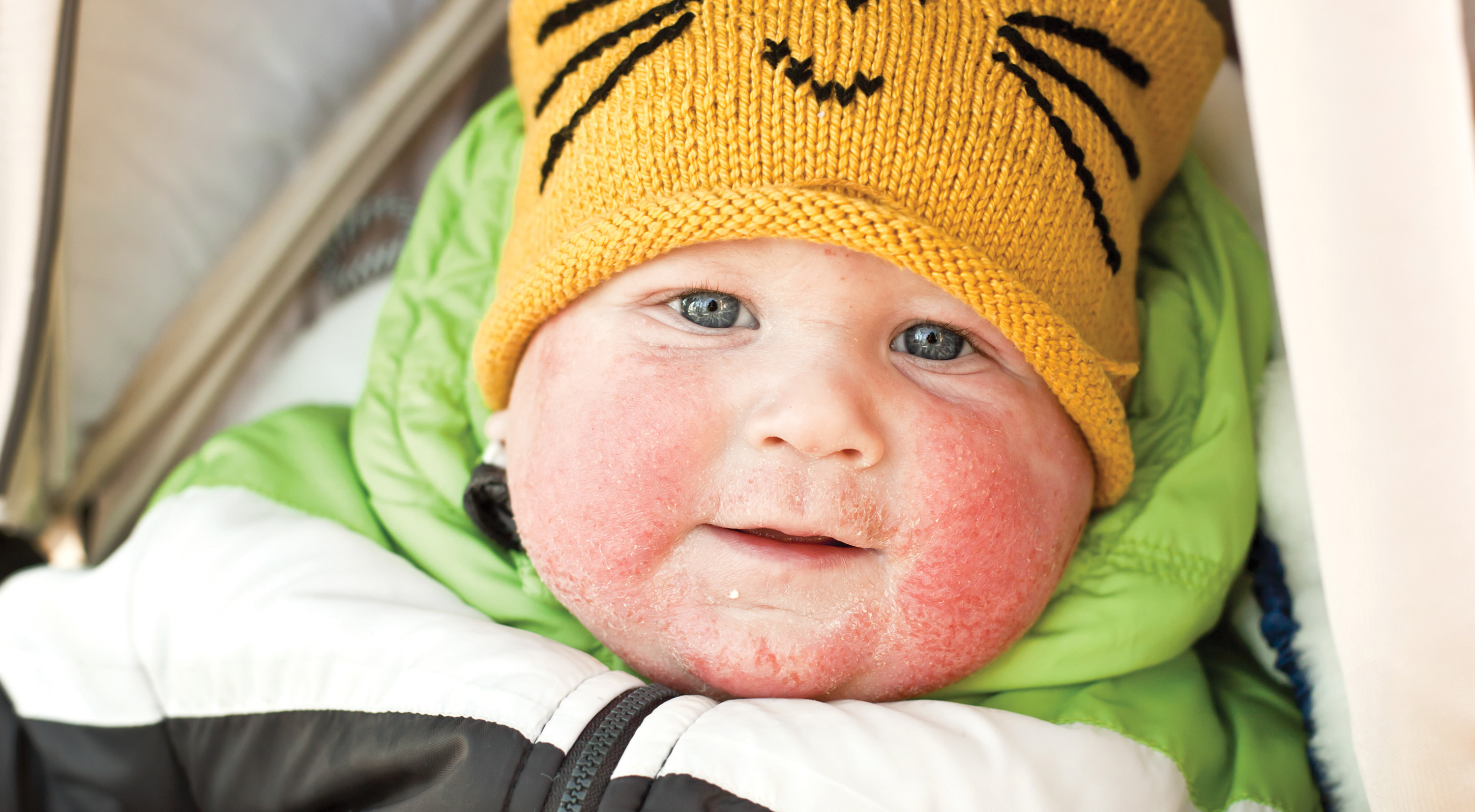 Pediatric Dermatology Topic Center | The Dermatologist