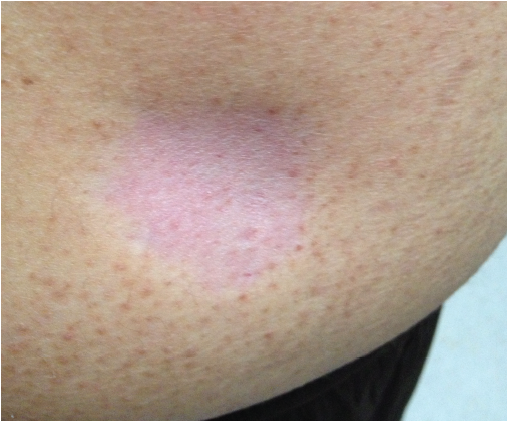 Volume 22 - Issue 6 - June 2014 | The Dermatologist