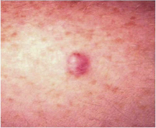 Dermatofibroma Dimple Sign