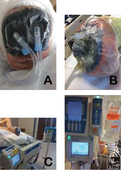 Morel-Lavallee Lesion