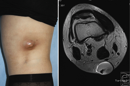 Malignant Tumor