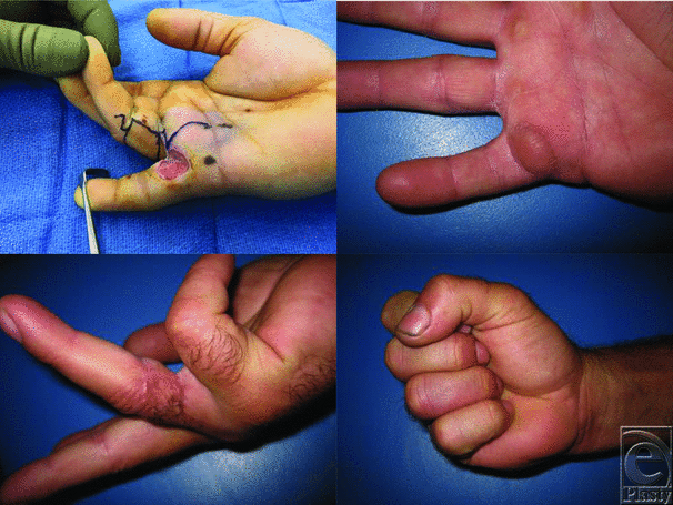 Finger Reconstruction Surgery
