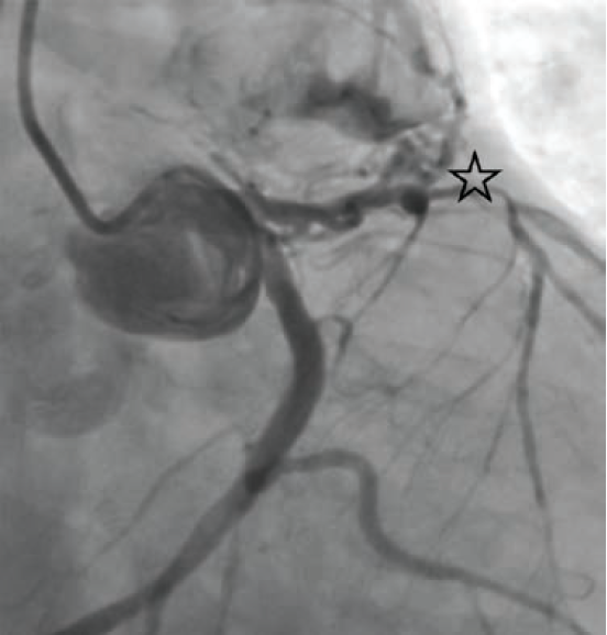 Coronary Artery Fistulas: Unmasking Acquired Origins in the Setting of ...