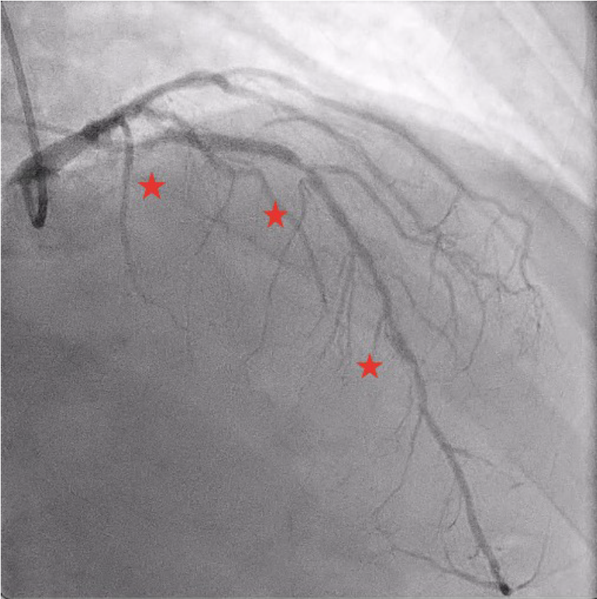 Plaque Modification Using the New LithiX Hertz Contact Lithotripsy ...
