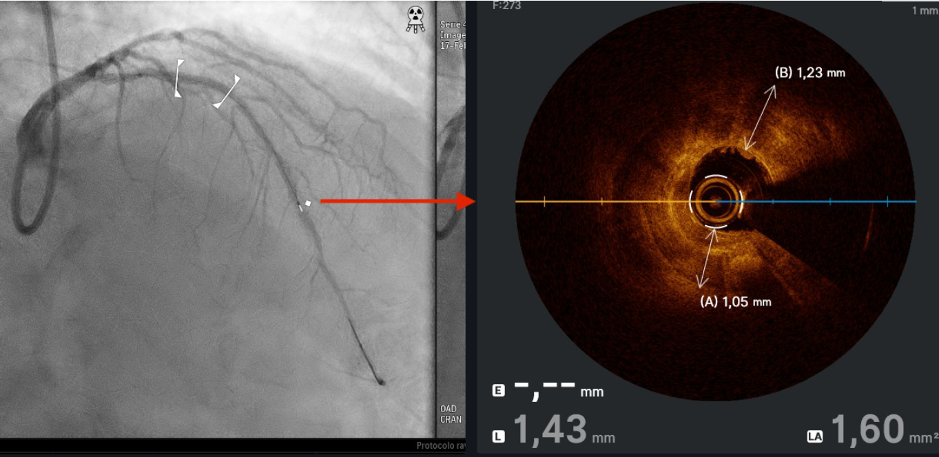 Plaque Modification Using the New LithiX Hertz Contact Lithotripsy ...