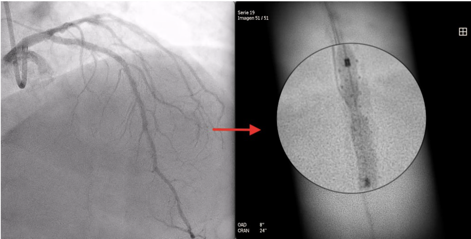 Plaque Modification Using the New LithiX Hertz Contact Lithotripsy ...