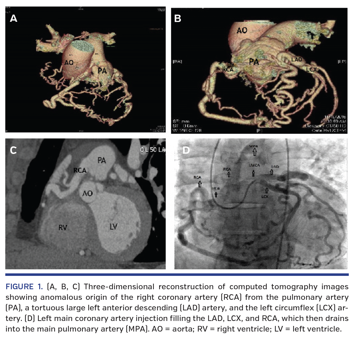 Multimodality Imaging of Anomalous Origin of Right Coronary Artery From ...