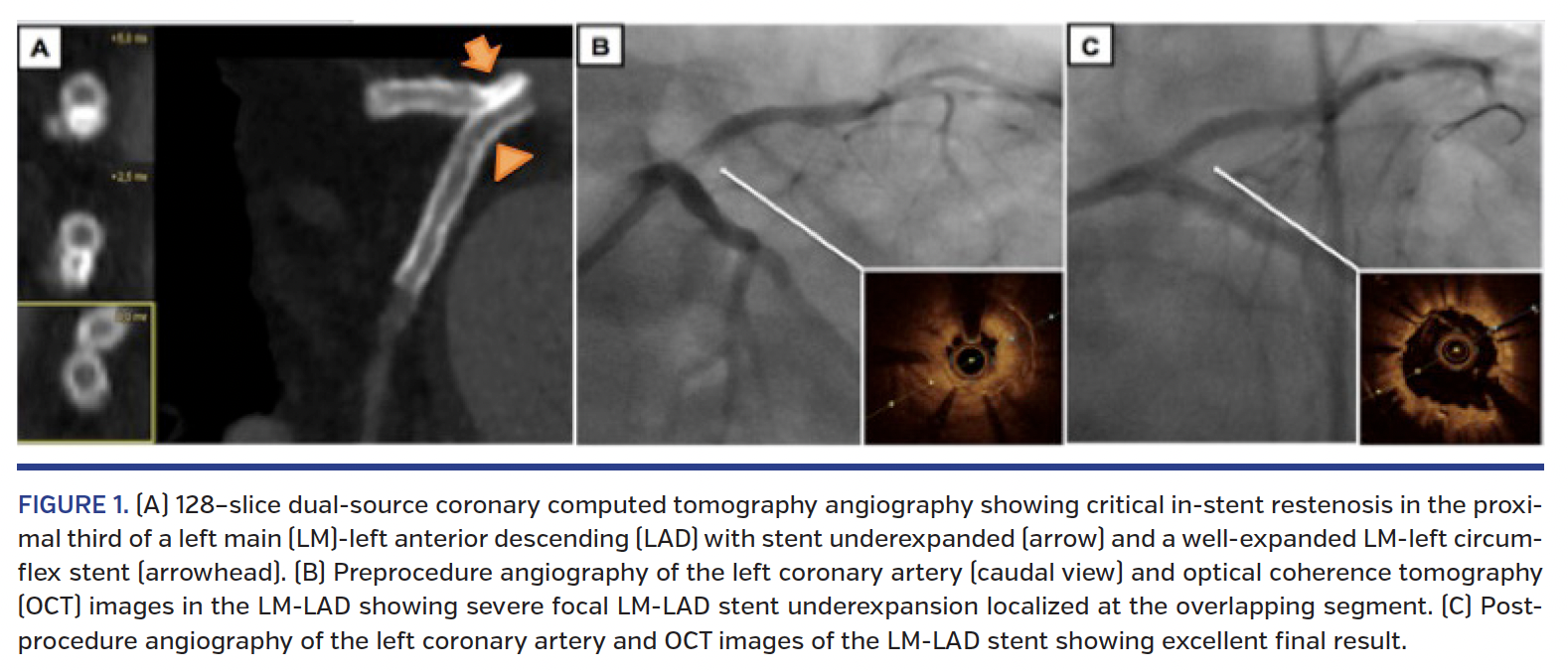 Coronary CT Angiography for In-Stent Restenosis: Diagnosis and ...