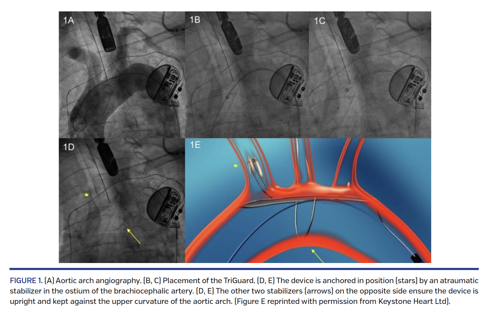 First-in-man Percutaneous LAA Closure With an Amplatzer Amulet and ...