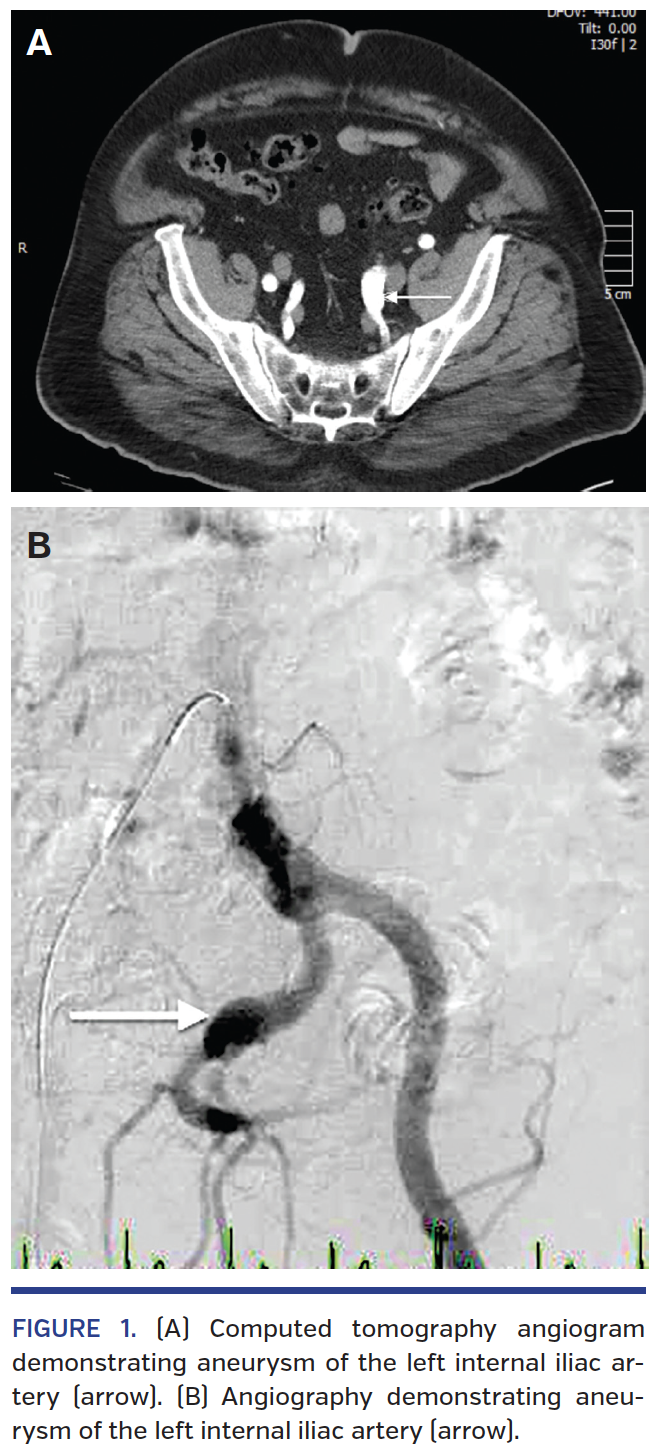 The Medusa Multi-Coil Versus Alternative Vascular Plugs for Iliac ...