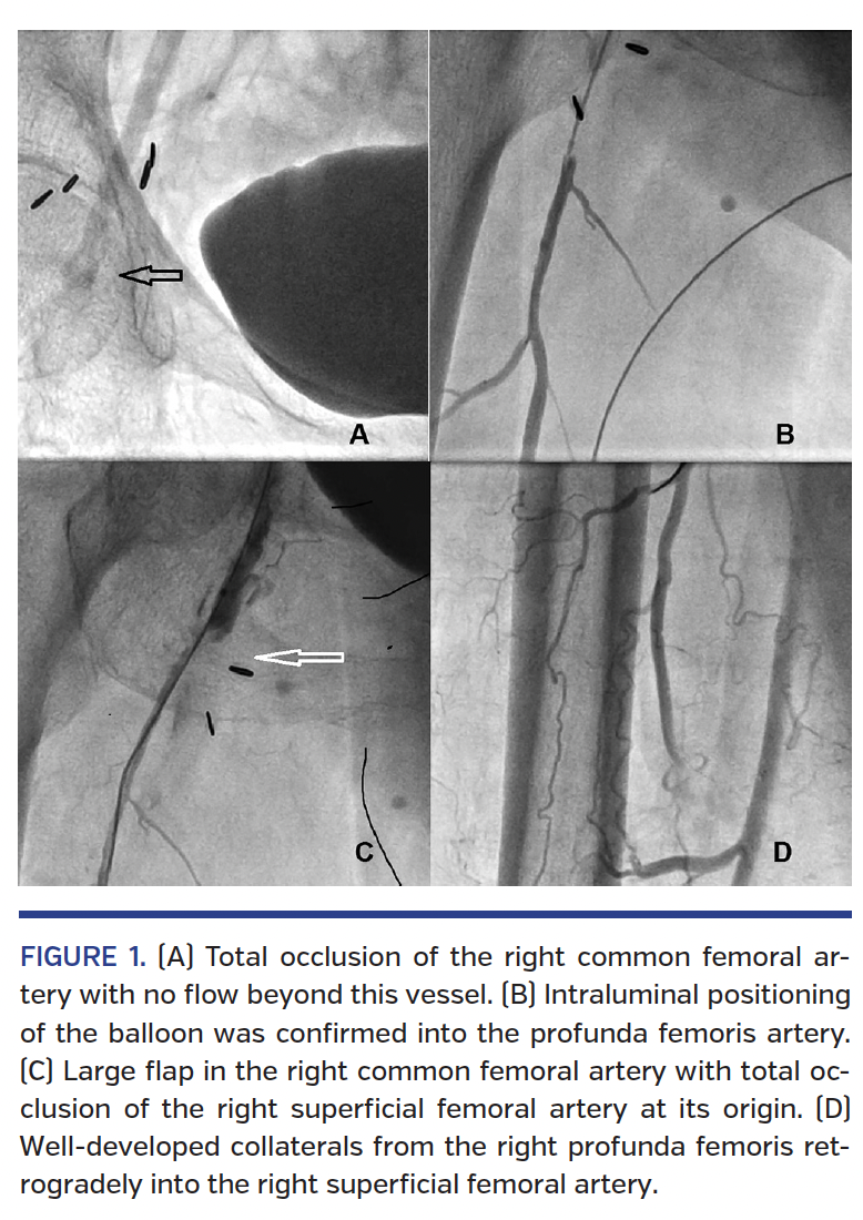 Recanalization of Total Occlusion of the Superficial Femoral Artery and ...