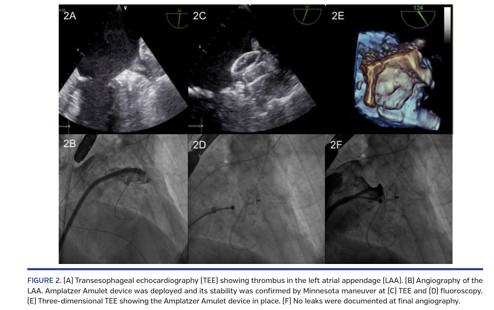First-in-man Percutaneous LAA Closure With an Amplatzer Amulet and ...