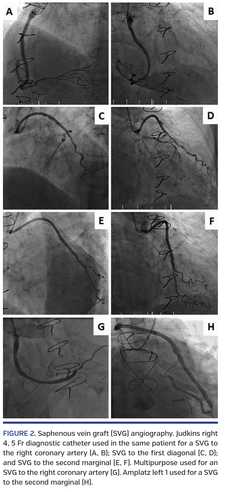 Transradial Approach for Post-Coronary Artery Bypass Graft Angiography ...