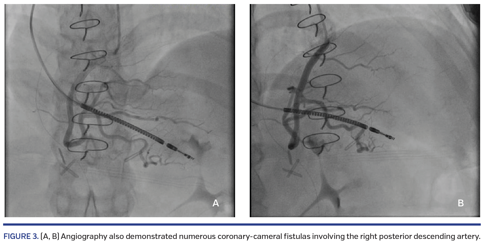 A Bleeding Heart: Coronary-Cameral Fistula After Septal Myomectomy