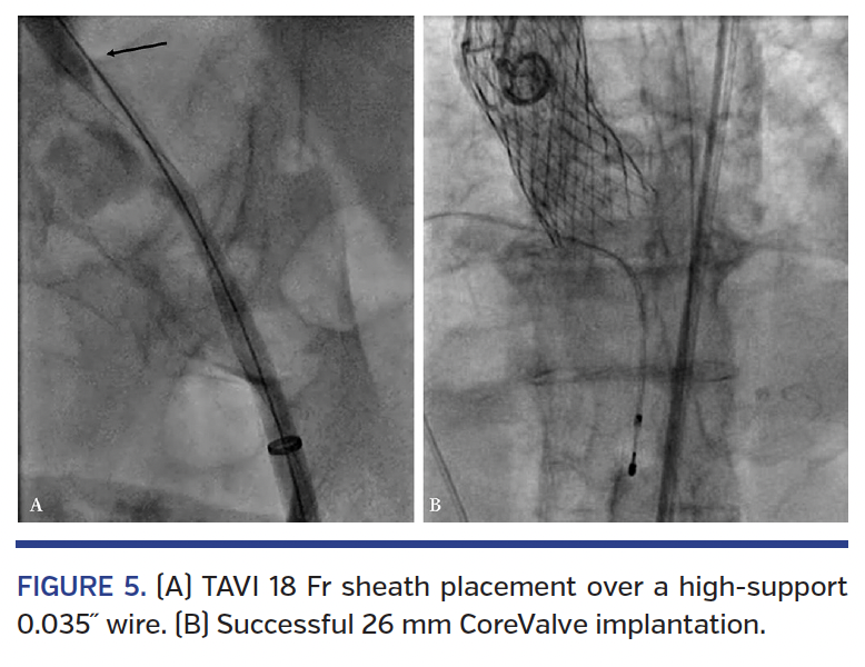 Bail-Out Use of Impella CP as a Bridge to TAVI in a Cardiogenic Shock ...