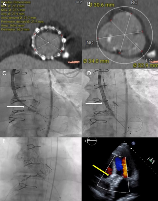 Snare Technique to Facilitate ‘Tall-in-Short’ Redo-TAVR