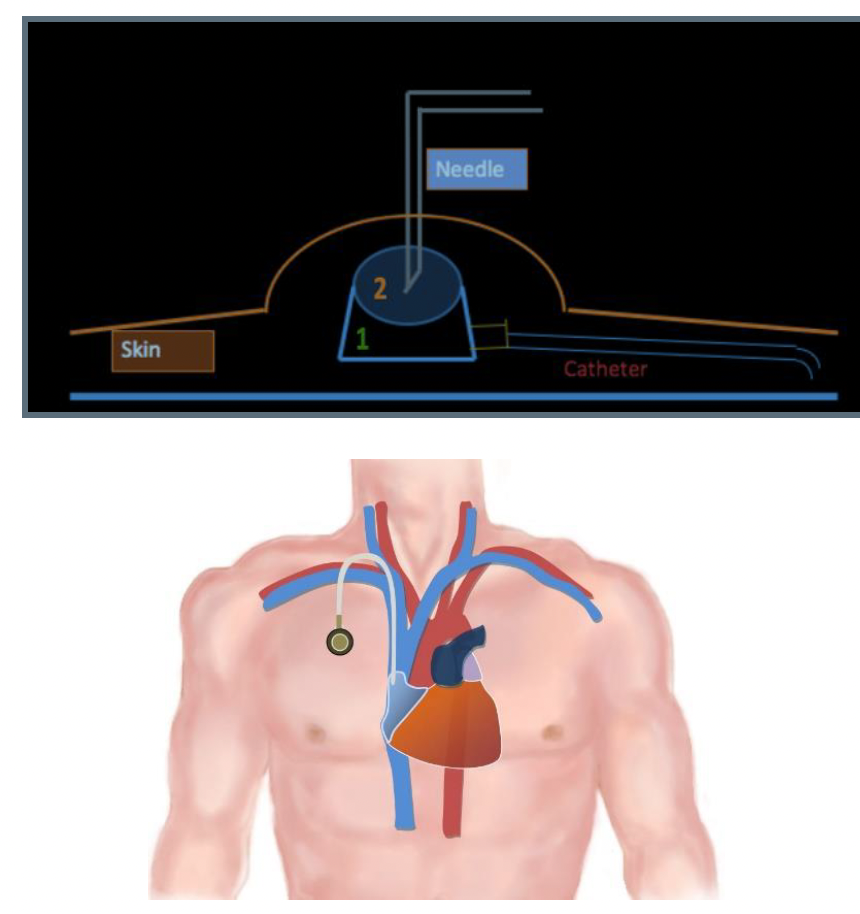 Chemoport Implantation by Interventional Radiologists | VDM