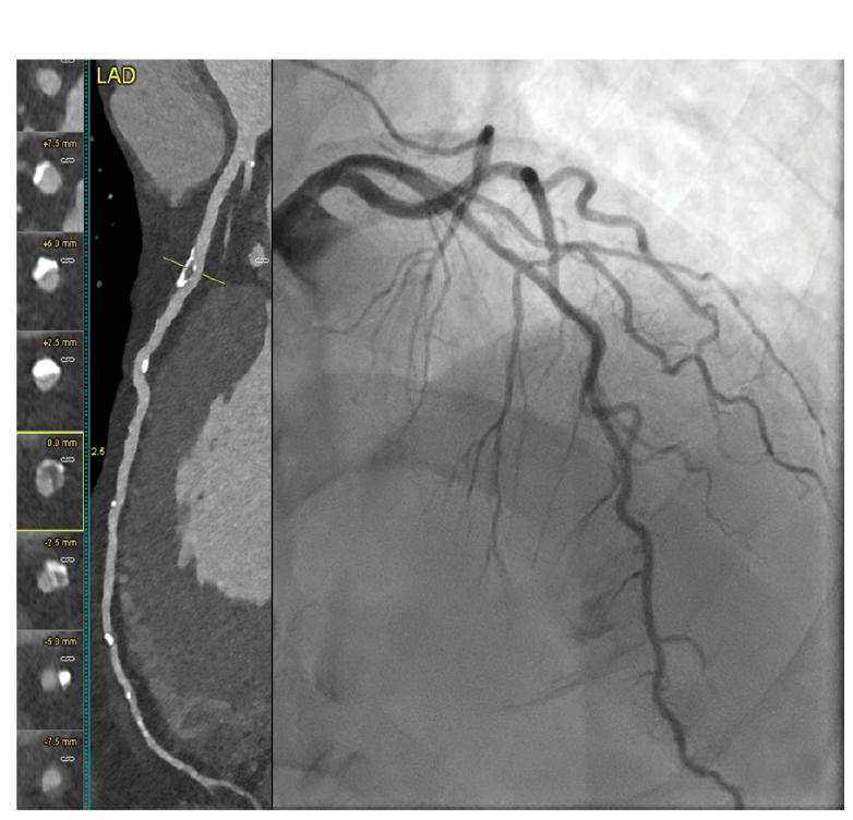 Using Photon-Counting CT to Image Stents in PCI Patients