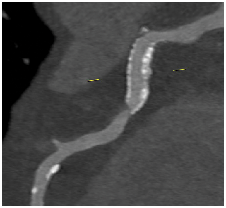 Using Photon-Counting CT to Image Stents in PCI Patients