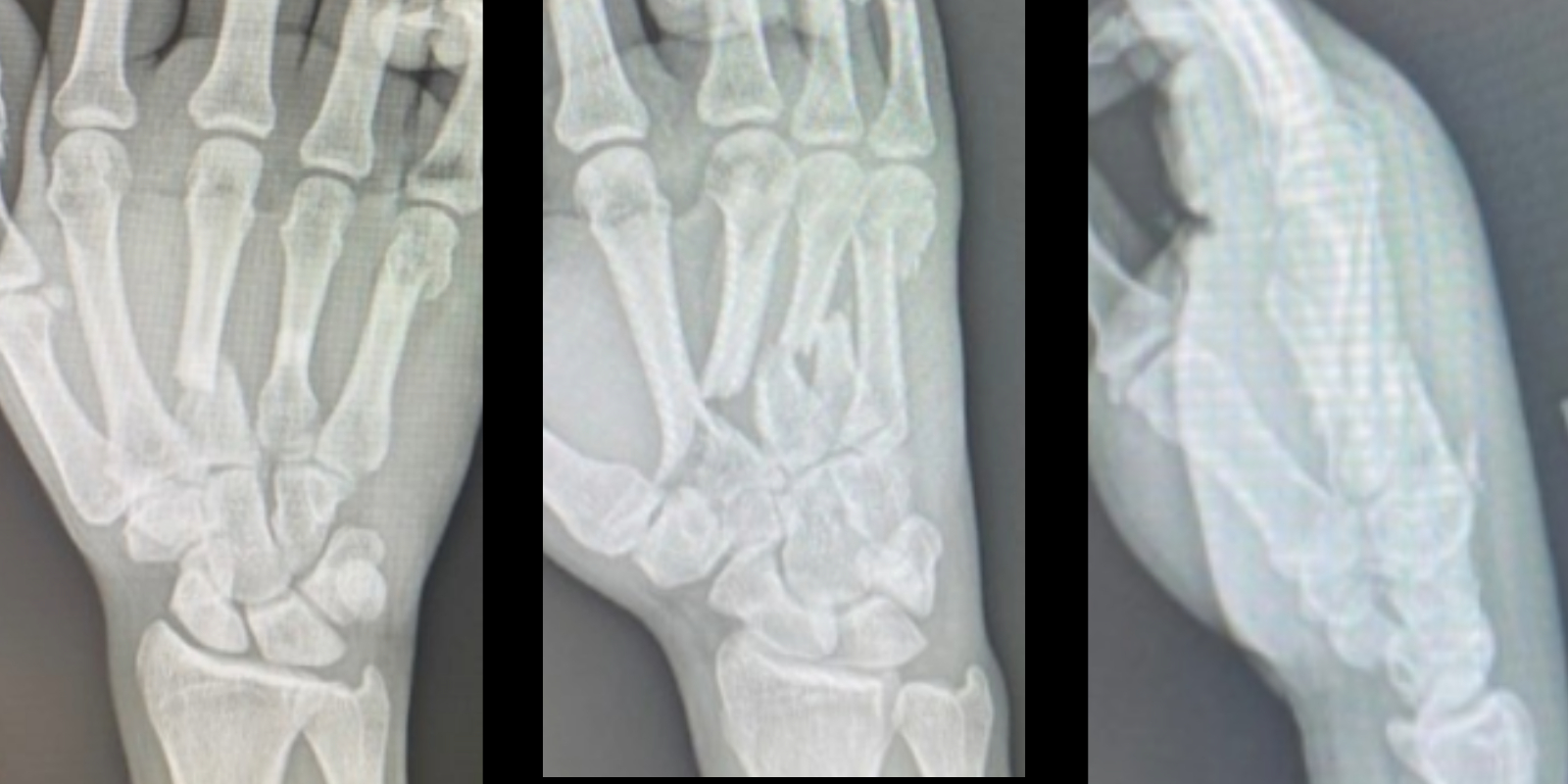 Wolverine Hand: Intramedullary Threaded Nail Fixation of Four ...