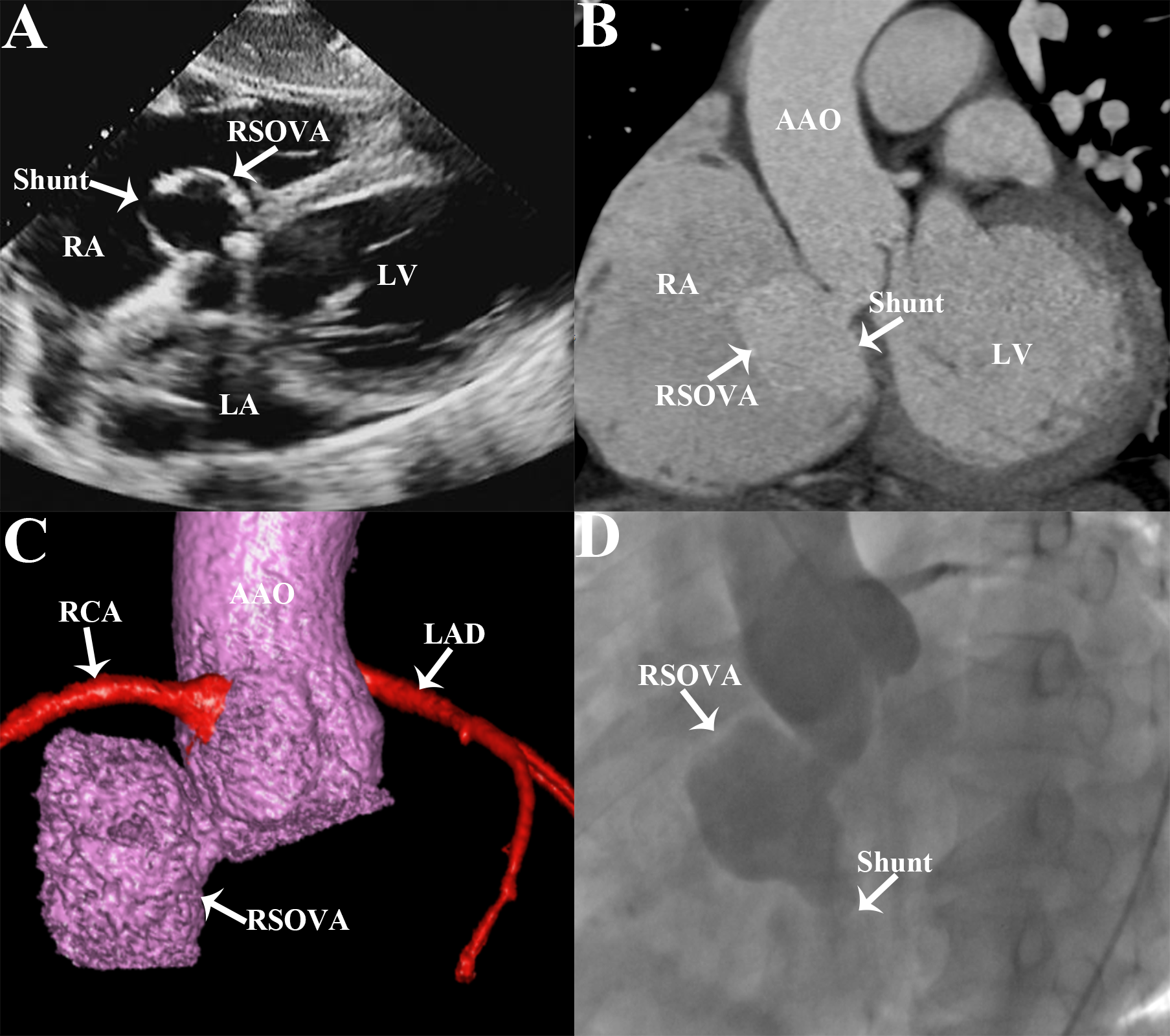 Transcatheter Closure of Ruptured Sinus of Valsalva Aneurysm Using a ...
