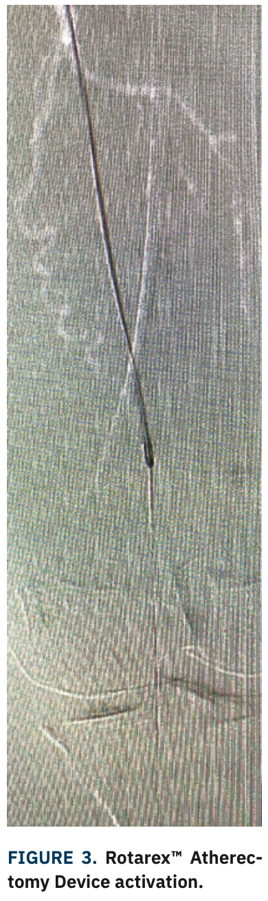 Rotational Excisional Atherectomy With the Rotarex™ Atherectomy Device